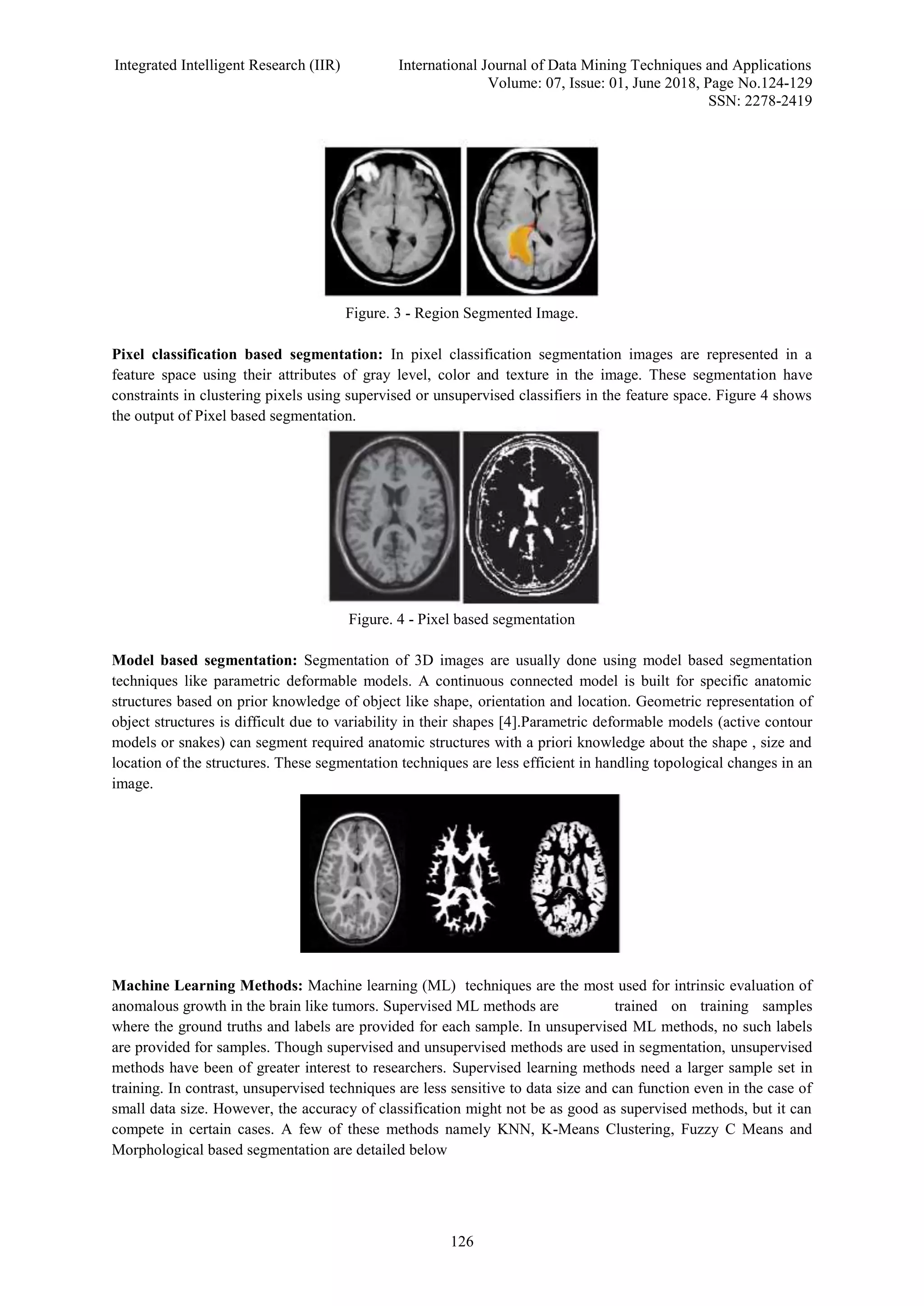 An Investigation into Brain Tumor Segmentation Techniques | PDF