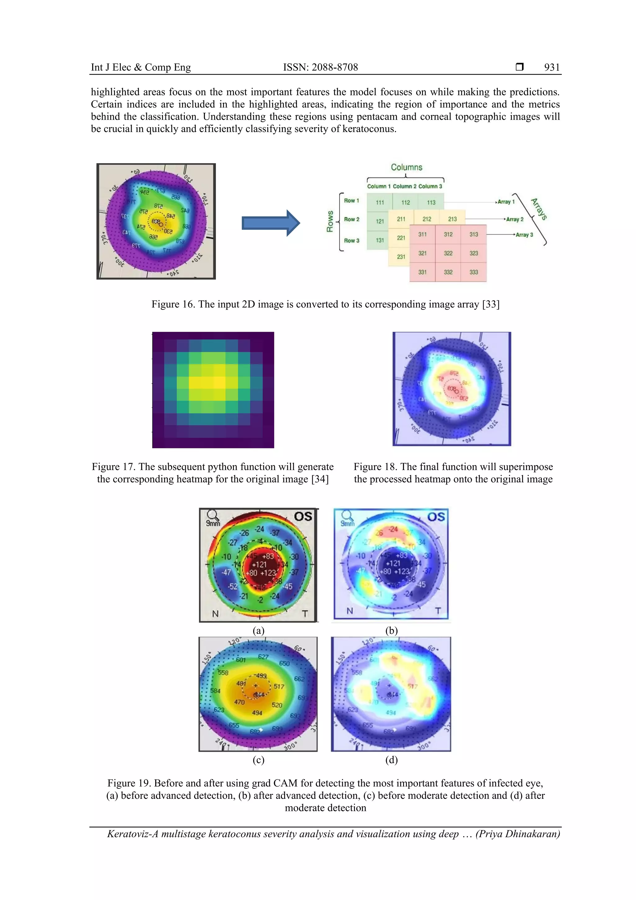 Keratoviz-A multistage keratoconus severity analysis and visualization using deep learning and ...