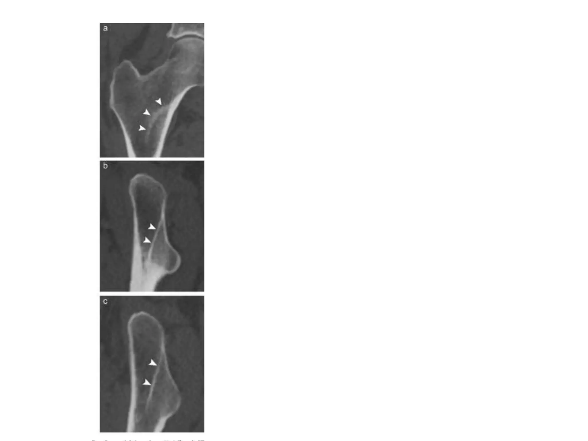 Intracapsular femoral neck fractures anatomy and biomechanics | PPTX