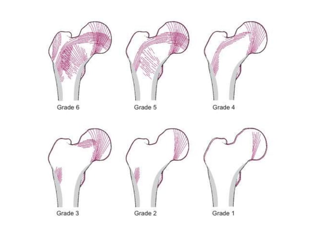 Intracapsular femoral neck fractures anatomy and biomechanics | PPTX