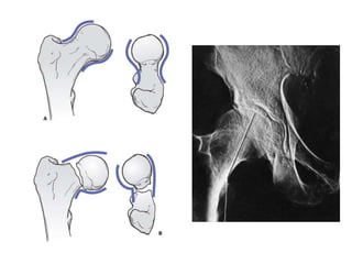 Intracapsular femoral neck fractures anatomy and biomechanics | PPTX