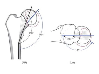 Intracapsular femoral neck fractures anatomy and biomechanics | PPTX