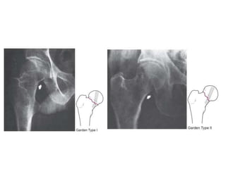 Intracapsular femoral neck fractures anatomy and biomechanics | PPTX