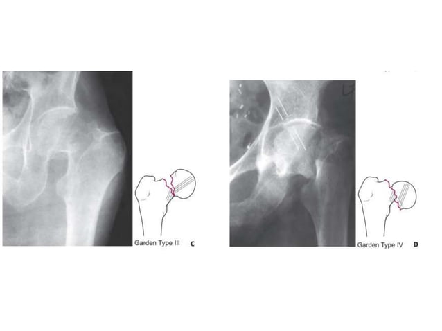 Intracapsular femoral neck fractures anatomy and biomechanics | PPTX