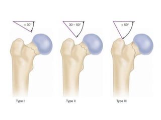 Intracapsular femoral neck fractures anatomy and biomechanics | PPTX