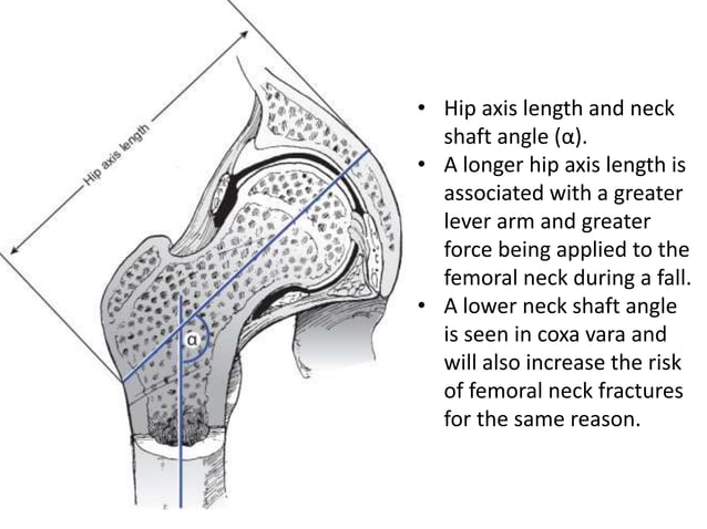 Intracapsular femoral neck fractures anatomy and biomechanics | PPT