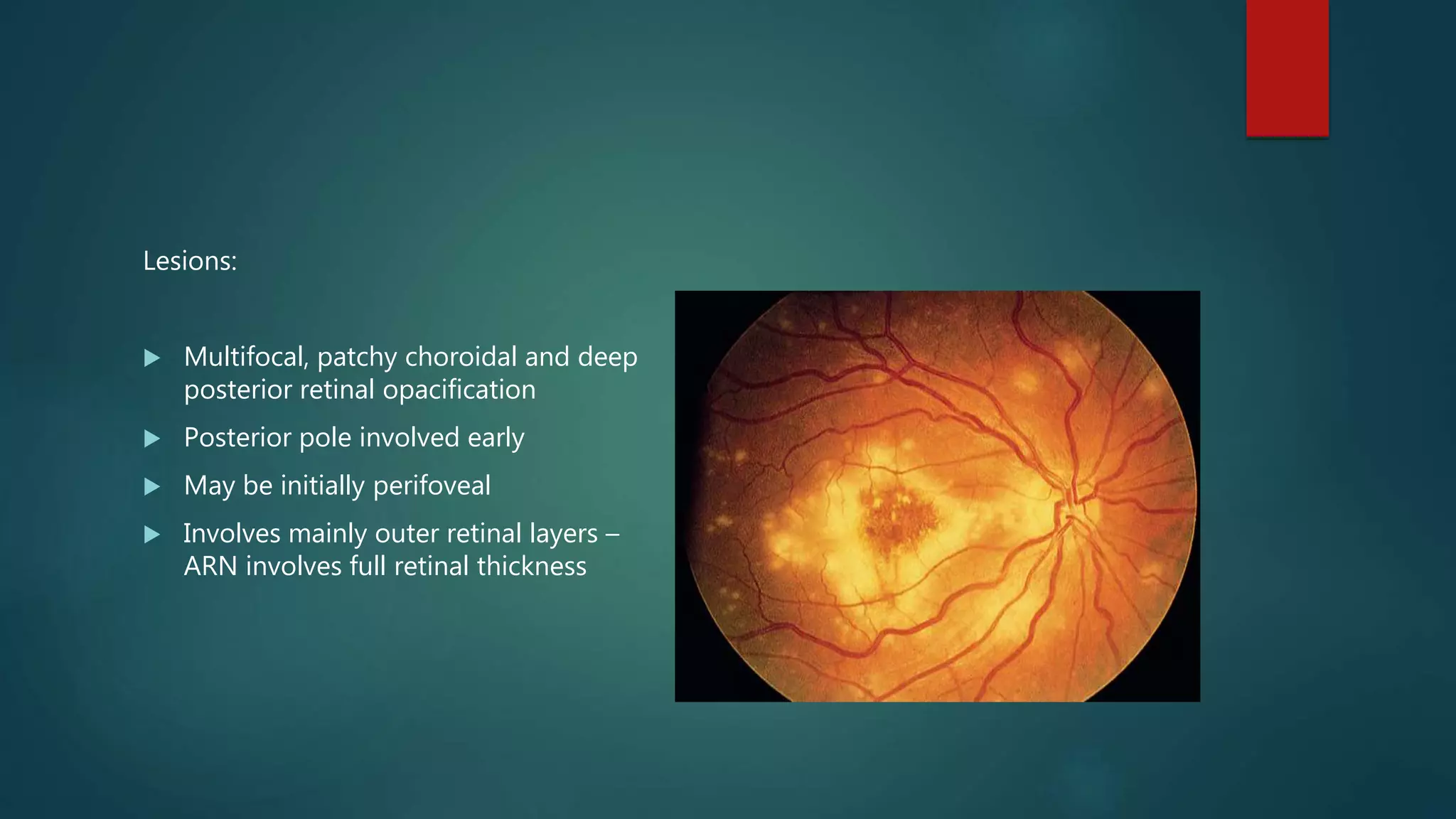 Acute retinal necrosis syndrome | PPTX