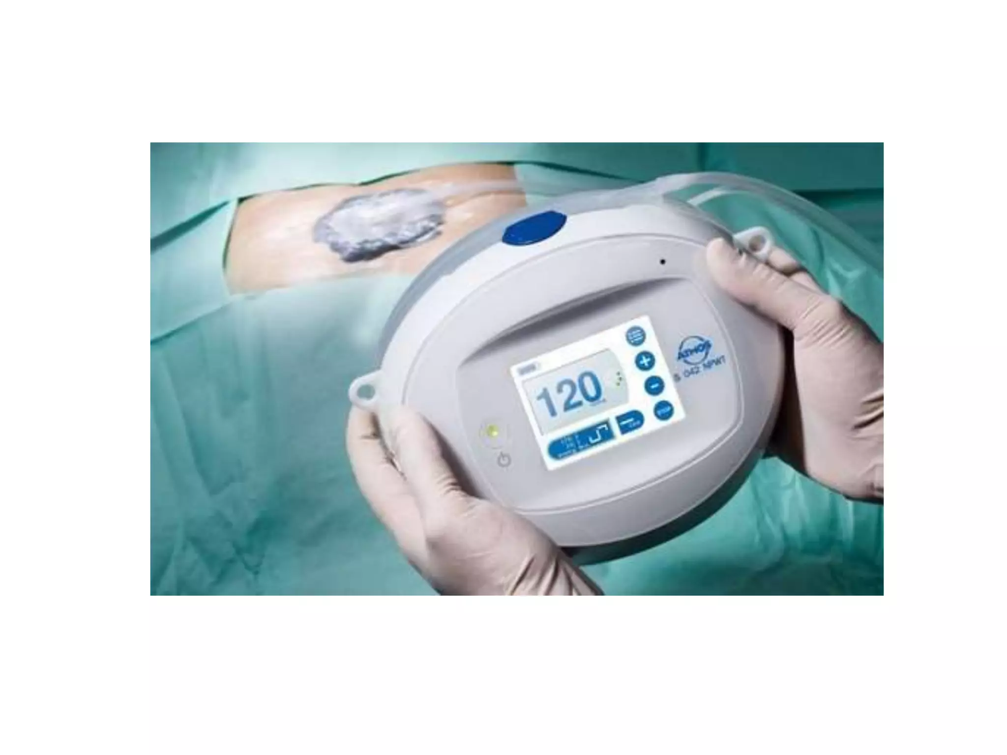 Vacuum assisted closure therapy | PPTX