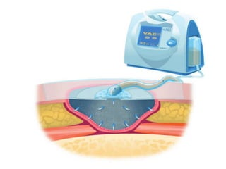 Vacuum assisted closure therapy | PPTX