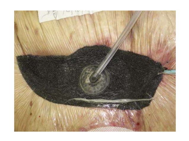 Vacuum assisted closure therapy | PPTX | Death, Injury, or Military ...