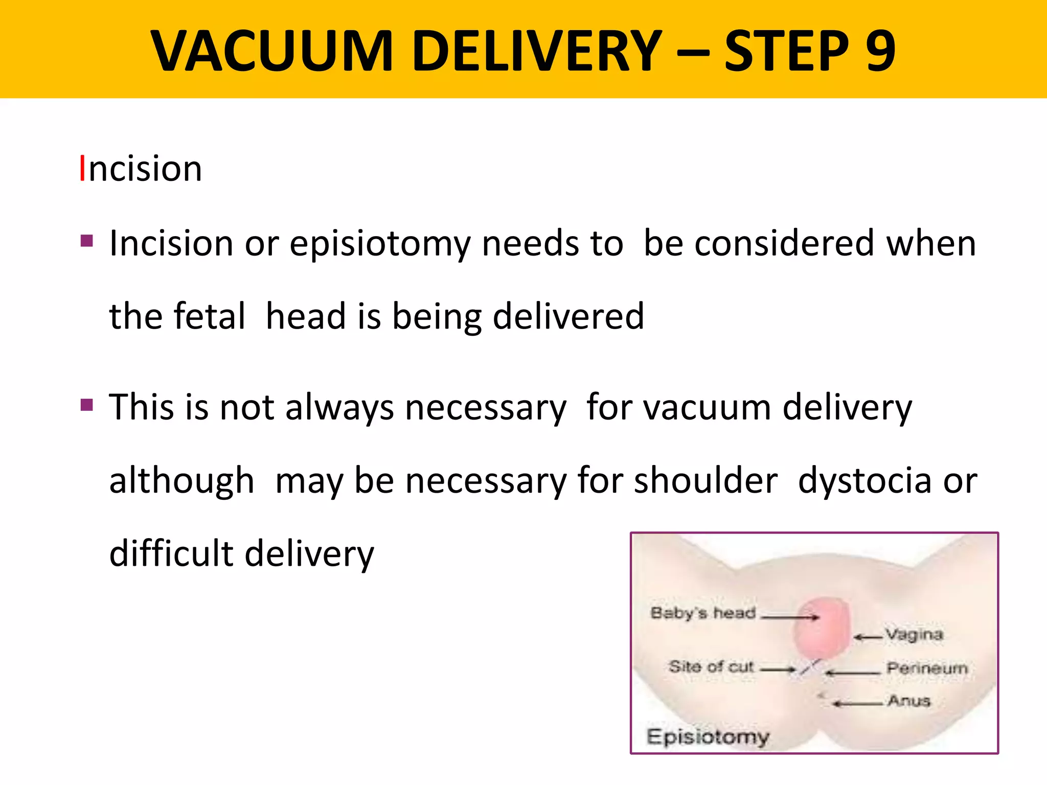 VACCUM ASSISTED DELIVERY | PPT