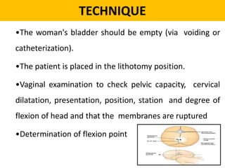 VACCUM ASSISTED DELIVERY | PPT