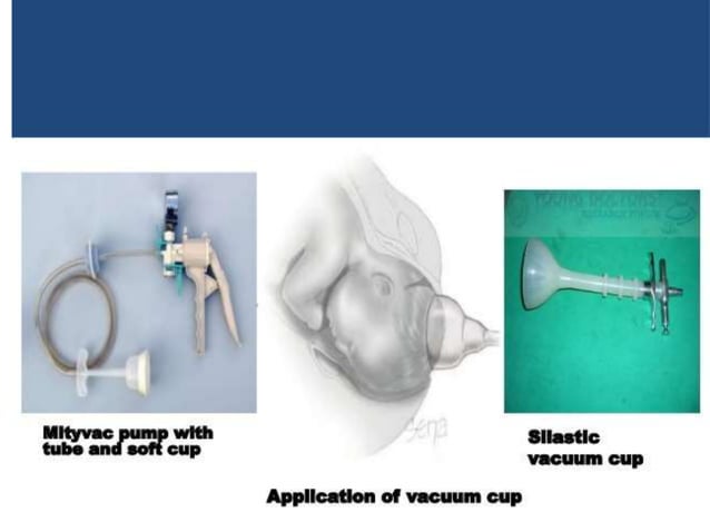 vaccum delivery.pptxfor nursing students | PPT