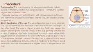 Vaccum extraction describes the delivery of baby using instruments | PPT