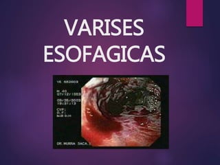 Vacrices esofagicas | PPTX