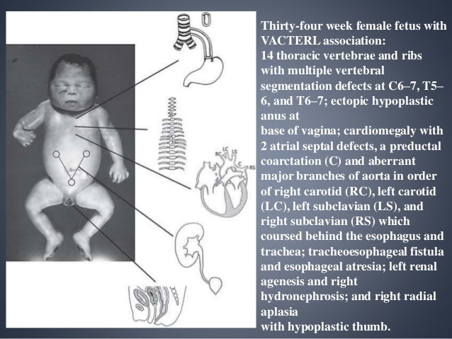 Vacterl association: embryology and recognition