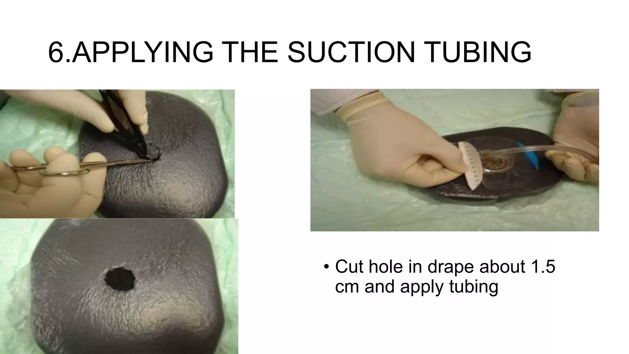 Vac therapy | PPTX