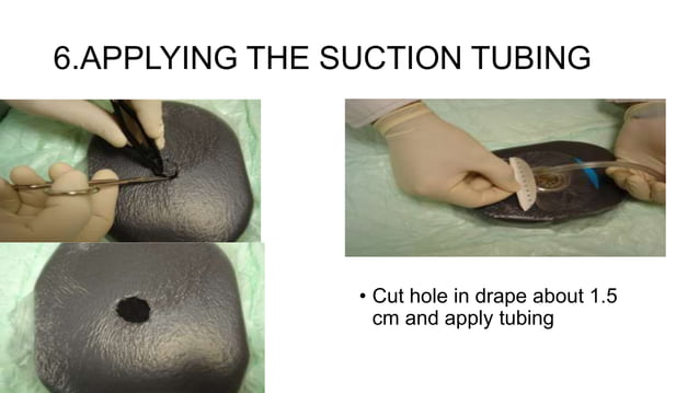 Vac therapy | PPTX