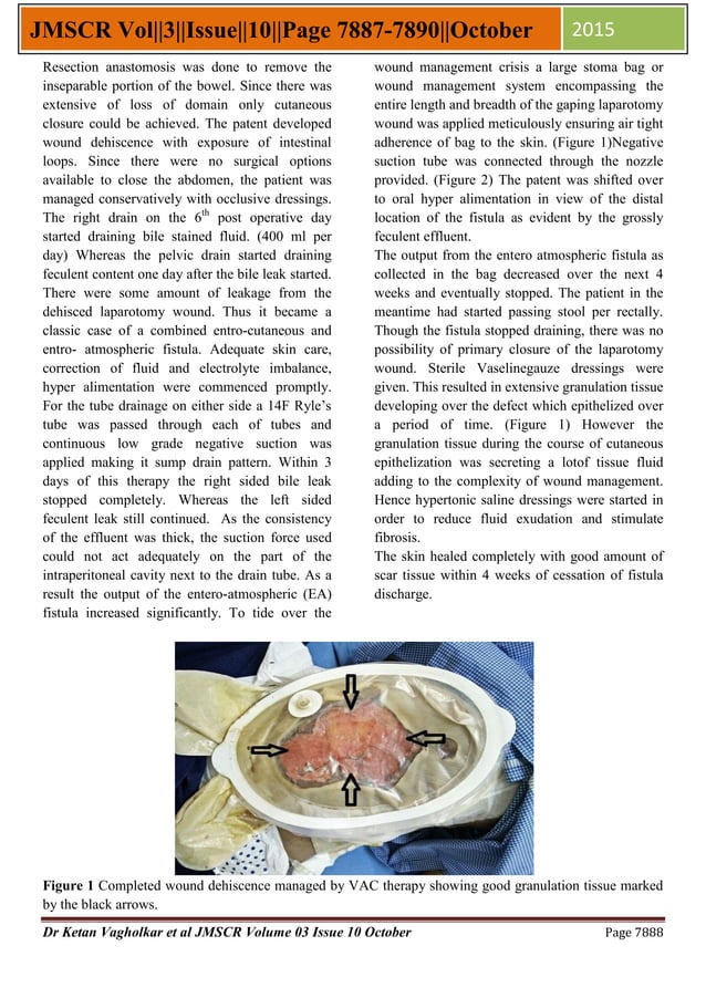 Vacuum Assisted Closure (VAC): A Promising Therapeutic Tool for ...
