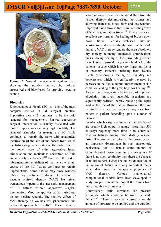 Vacuum Assisted Closure (VAC): A Promising Therapeutic Tool for ...
