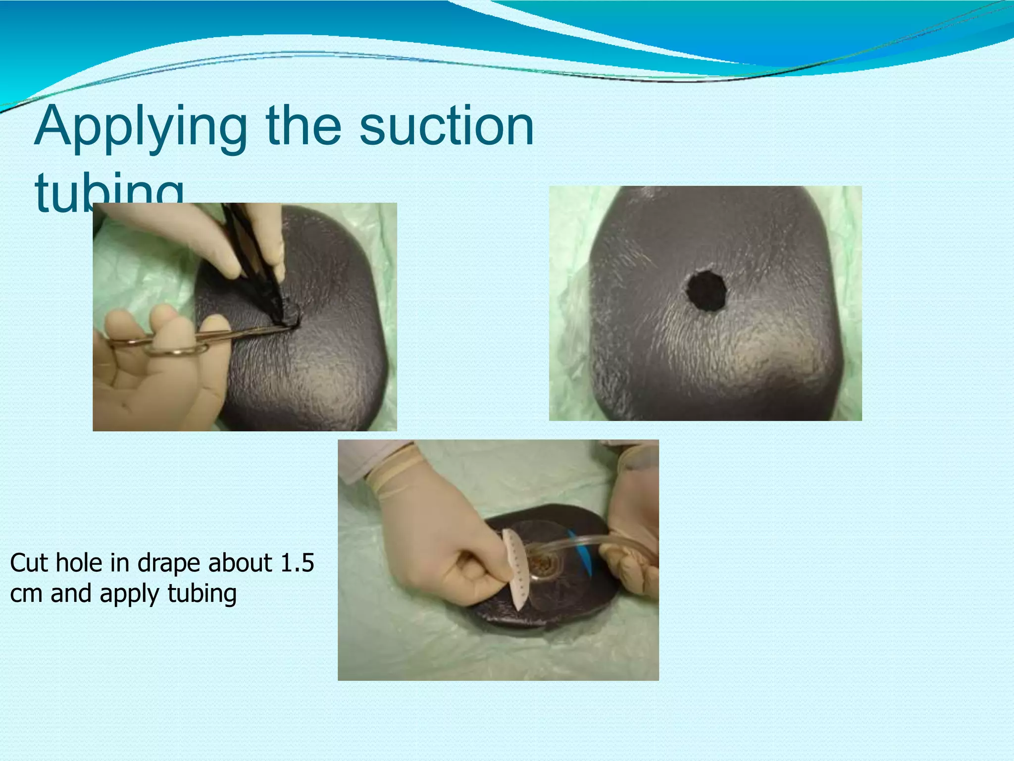 vacuum assisted closure of wound.pptx