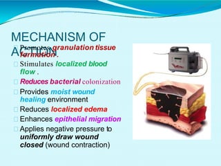 vacuum assisted closure of wound.pptx