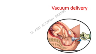 Types Of Vacuum Delivery