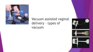 vacuum delivery during the intrapartum period.pptx