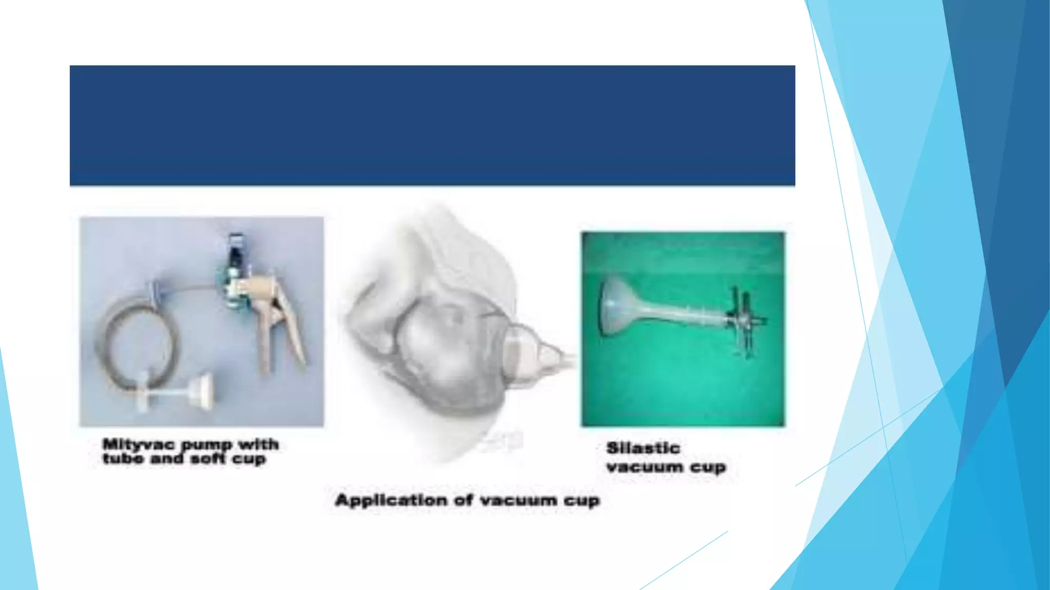 Vacuum Extraction of fetus.pptx