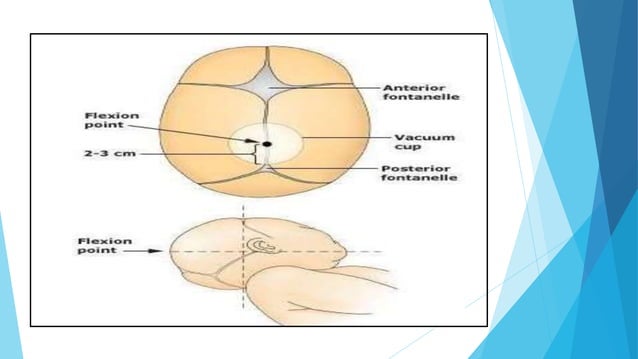 Vacuum Extraction of fetus.pptx