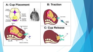 [Caesarean Section With Vacuum Extraction Of The Head] – JMNG