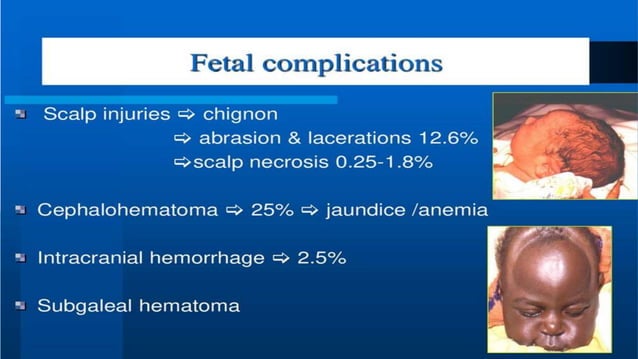 Vacuum Extraction of fetus.pptx