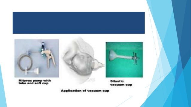 Vacuum Extraction of fetus.pptx