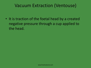 Vacuum extraction (ventouse) | PPTX