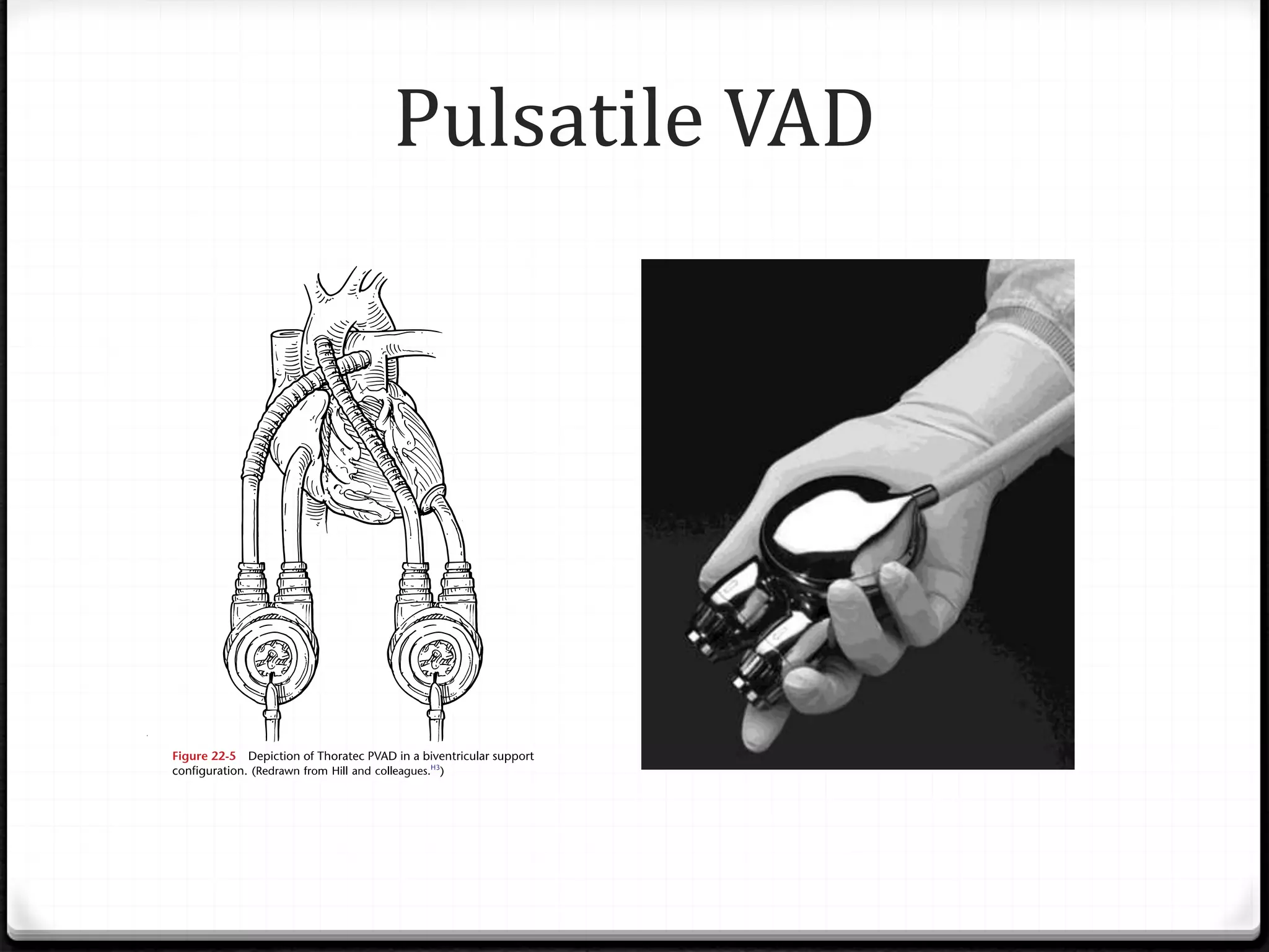 Ventricular assist devices | PPTX