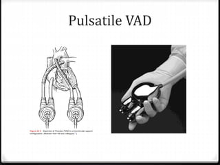 Ventricular assist devices | PPTX