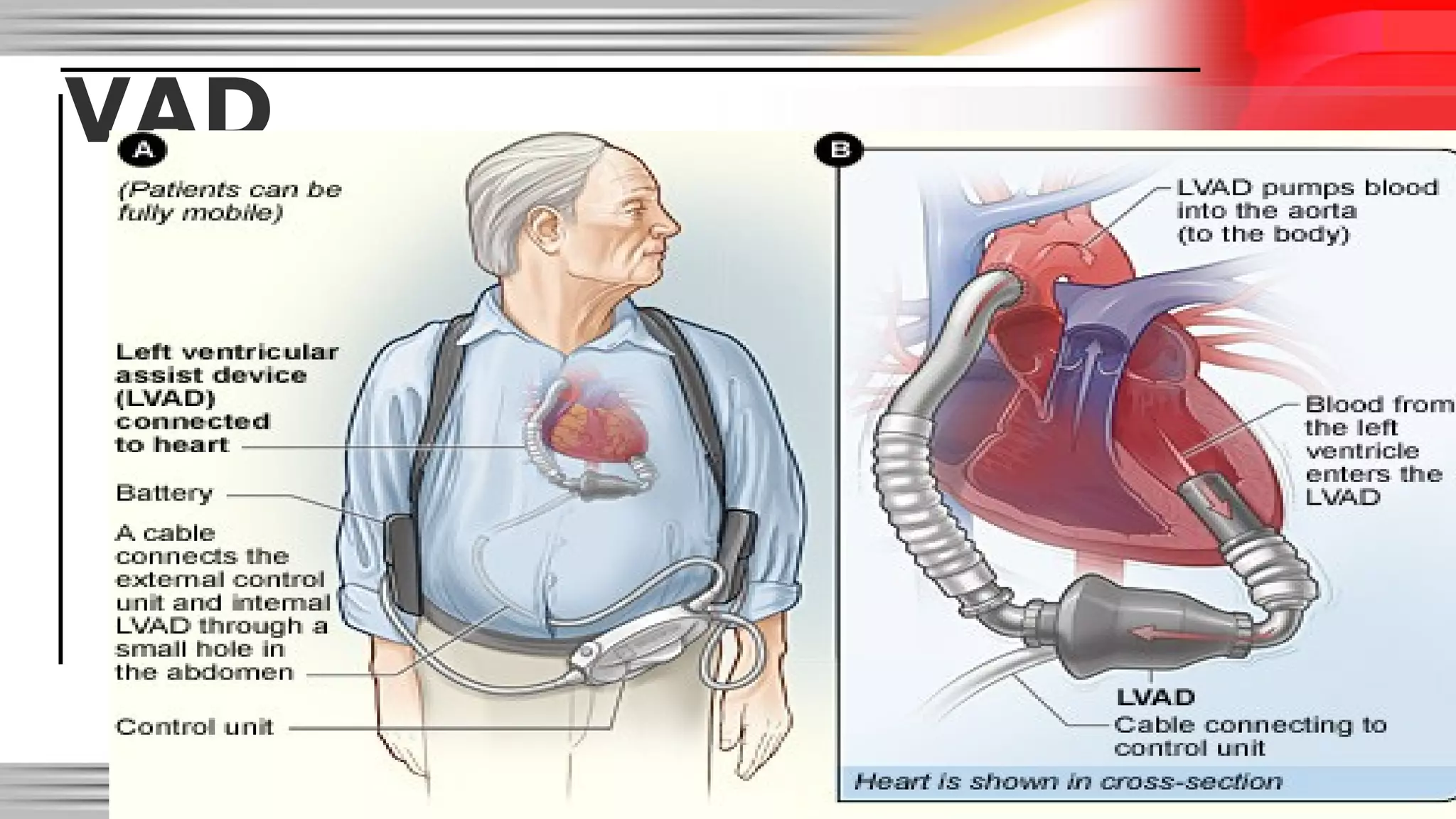 VAD Ventricular Assist Device | PPT