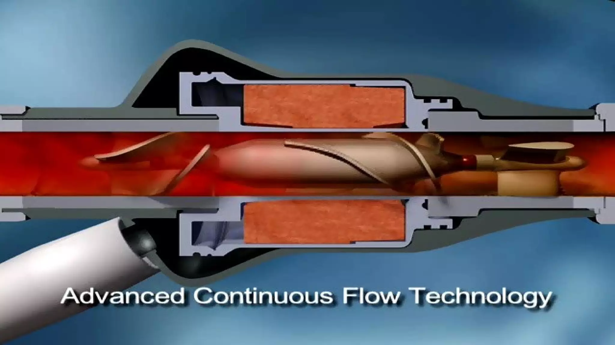 VAD Ventricular Assist Device | PPT