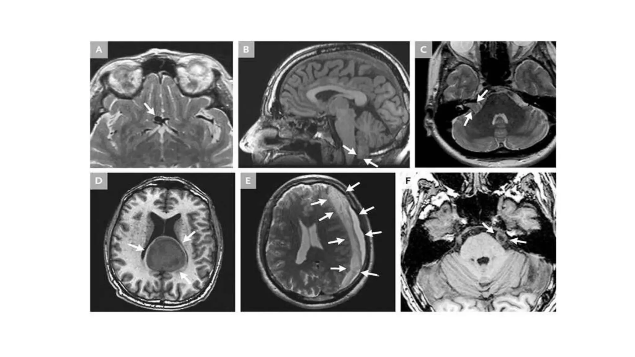 mri and amnesia-2.pptx