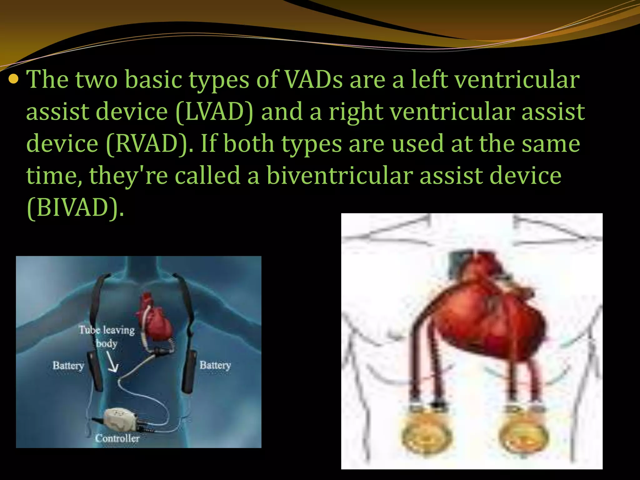 Ventricular Assist Device | PPTX