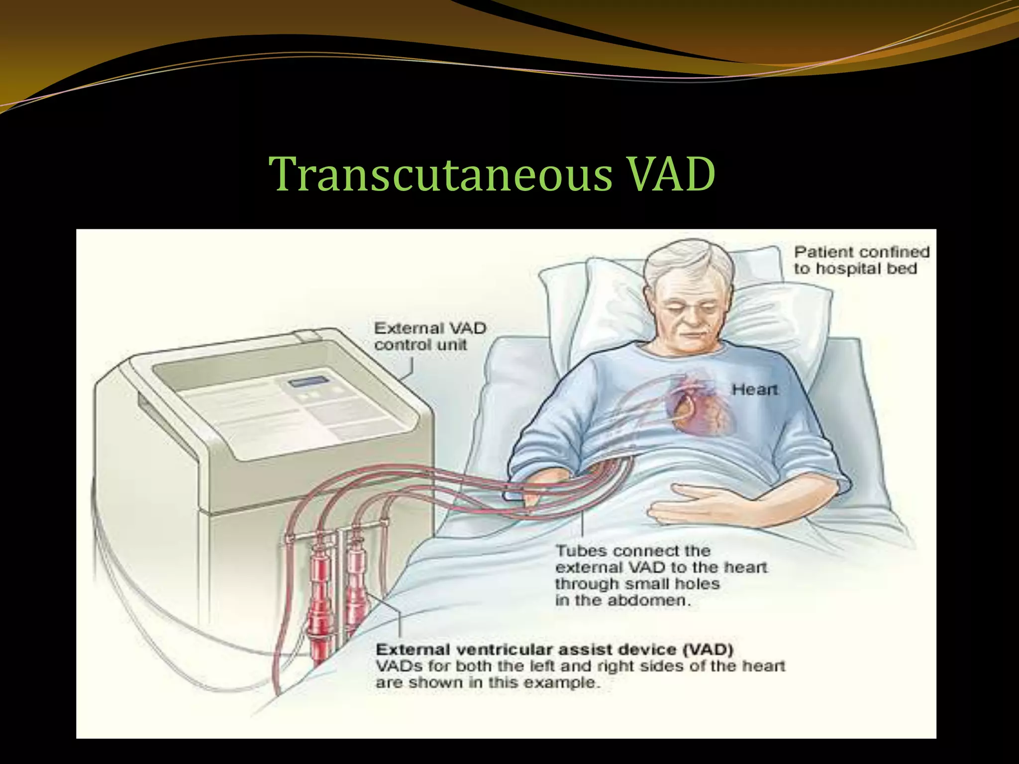 Ventricular Assist Device | PPTX