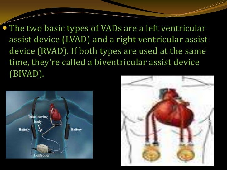 Ventricular Assist Device