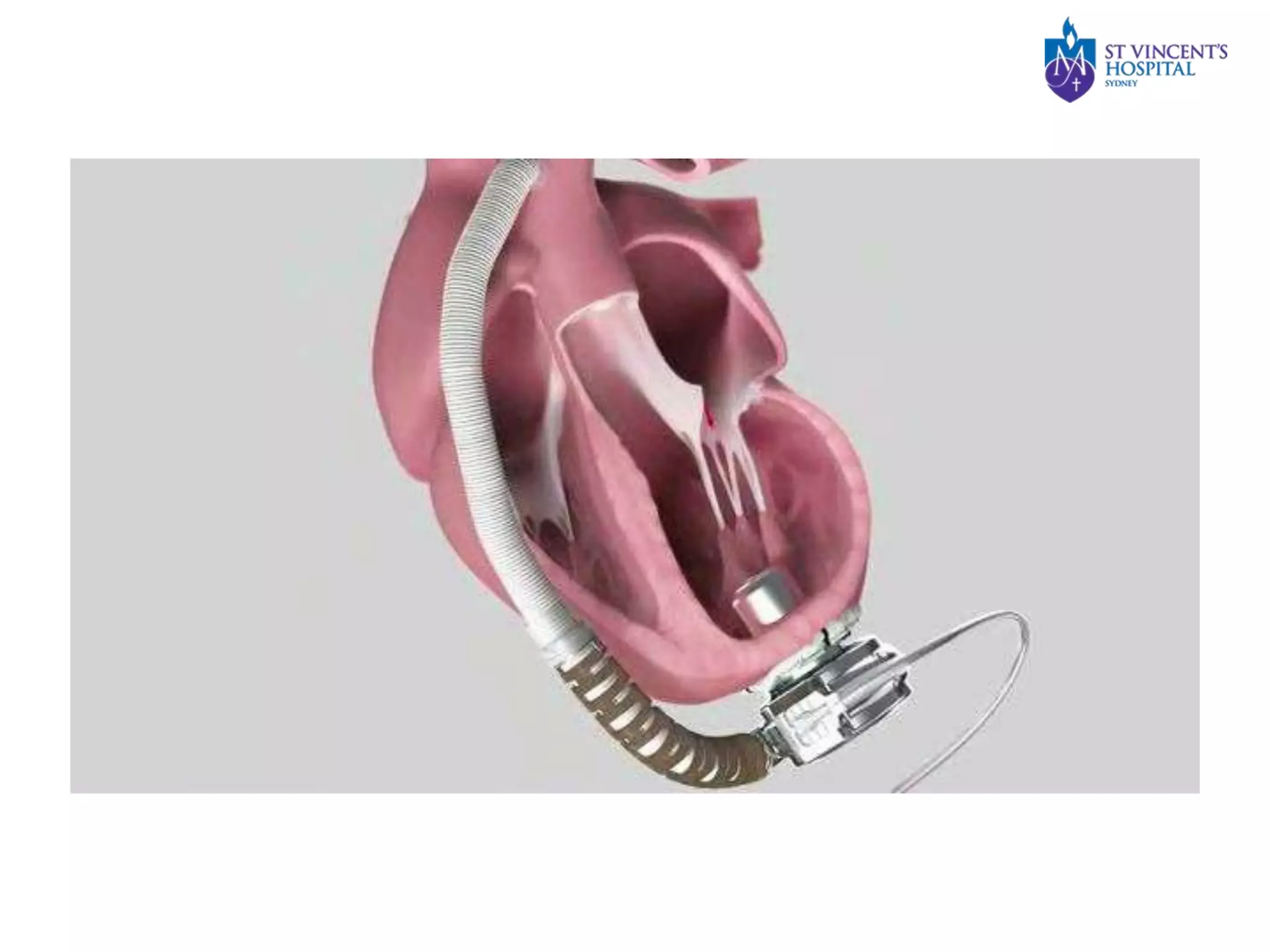 Ventricular Assist Devices | PPTX
