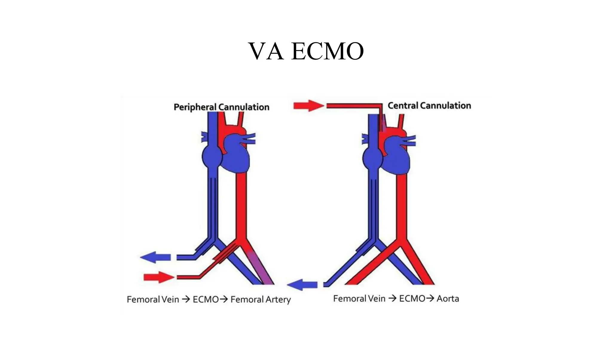 VenoArterila ECMO - 006.pptx