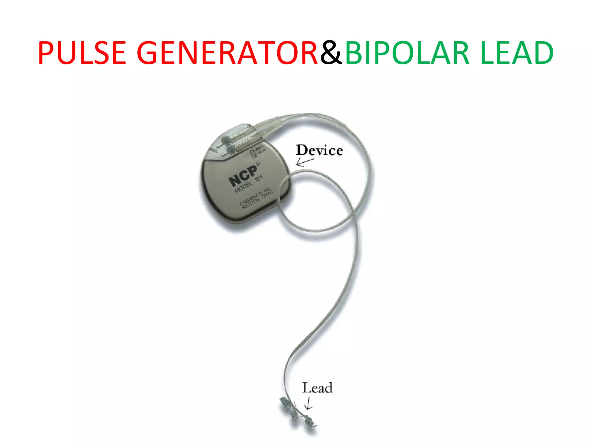Vagal Nerve Stimulation for epilepsy | PPT