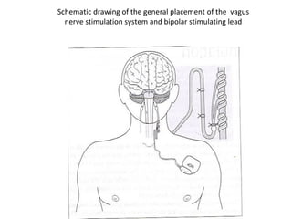 Vagal Nerve Stimulation for epilepsy | PPT