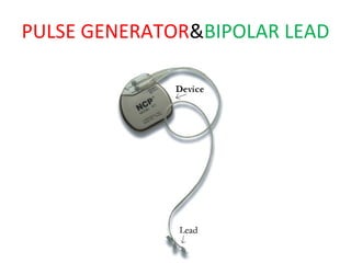 Vagal Nerve Stimulation for epilepsy | PPT