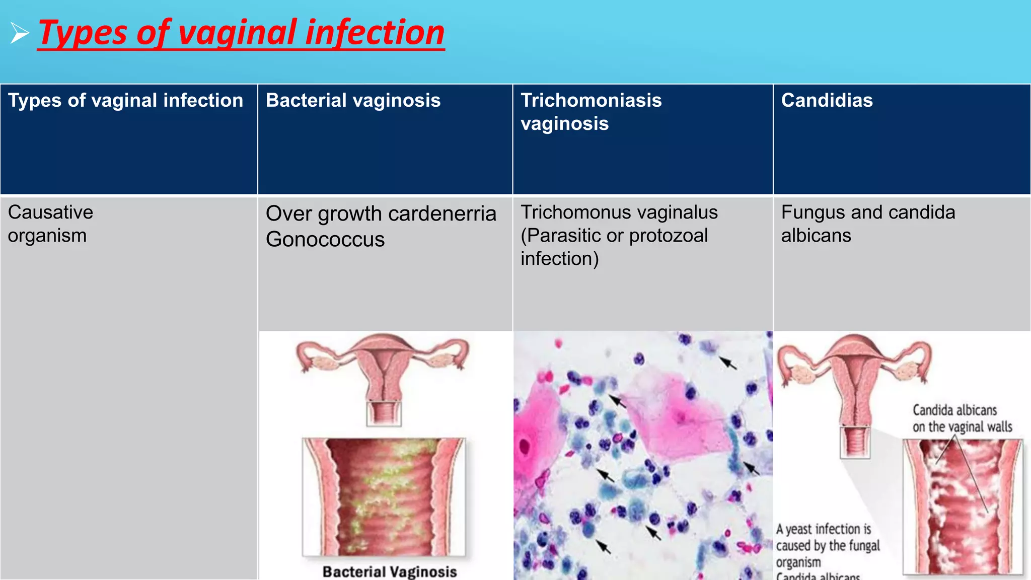 Vaginal infection | PPTX