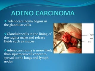 Vaginal Cancer | PDF