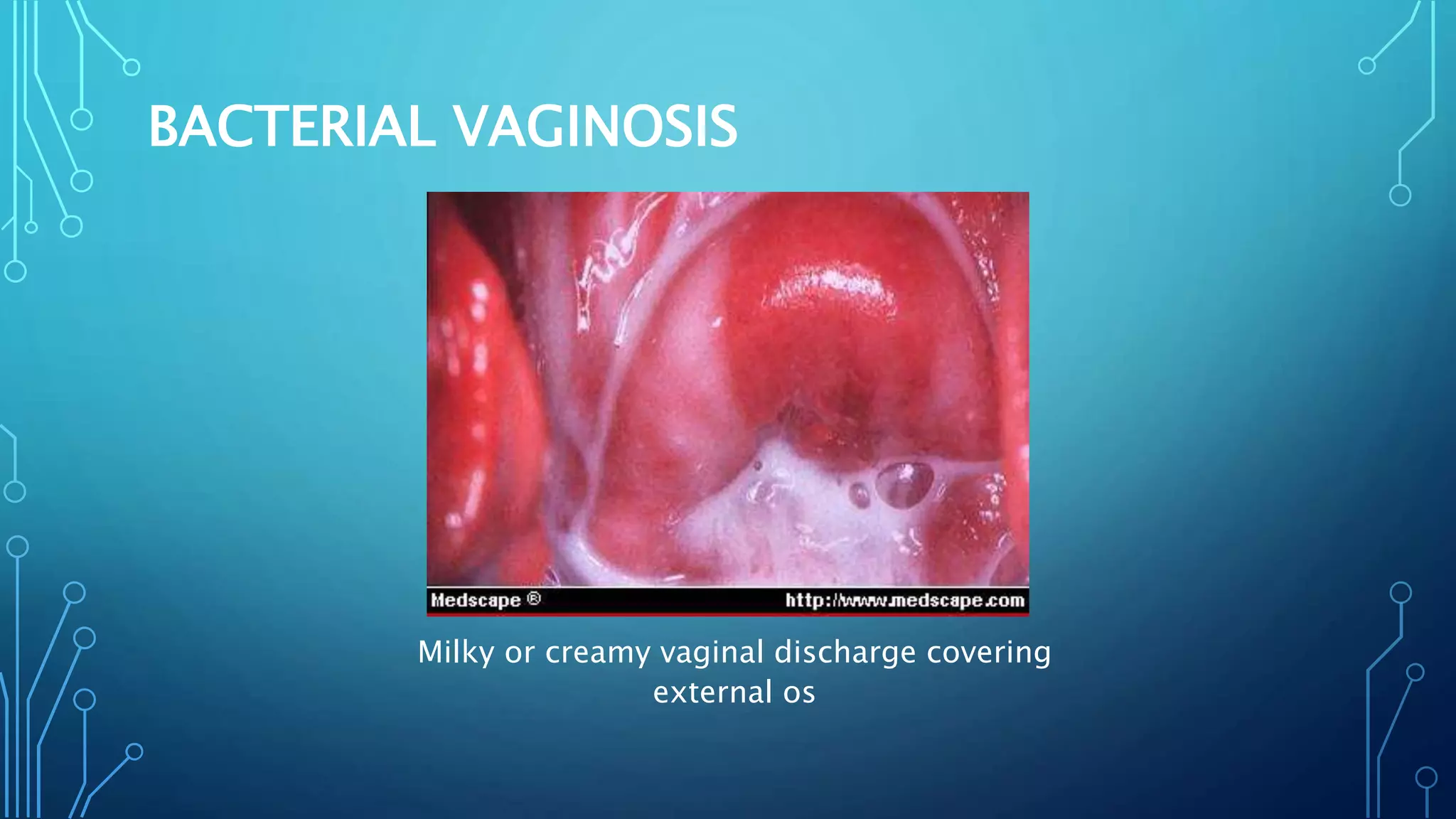 Vaginal Discharge | PPTX